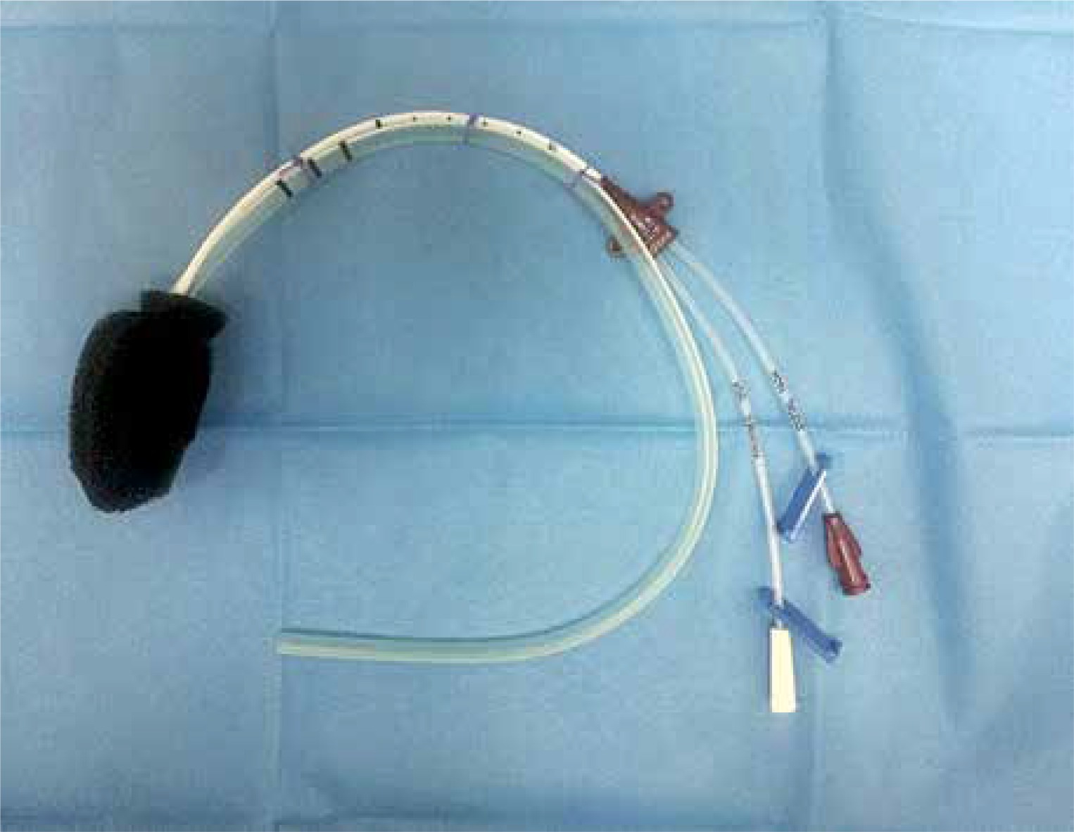 Endoscopic vacuum therapy with instillation (iEVT) – a novel endoscopic ...